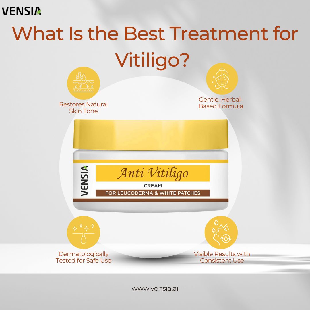 What Is the Best Treatment for Vitiligo? | Vensia