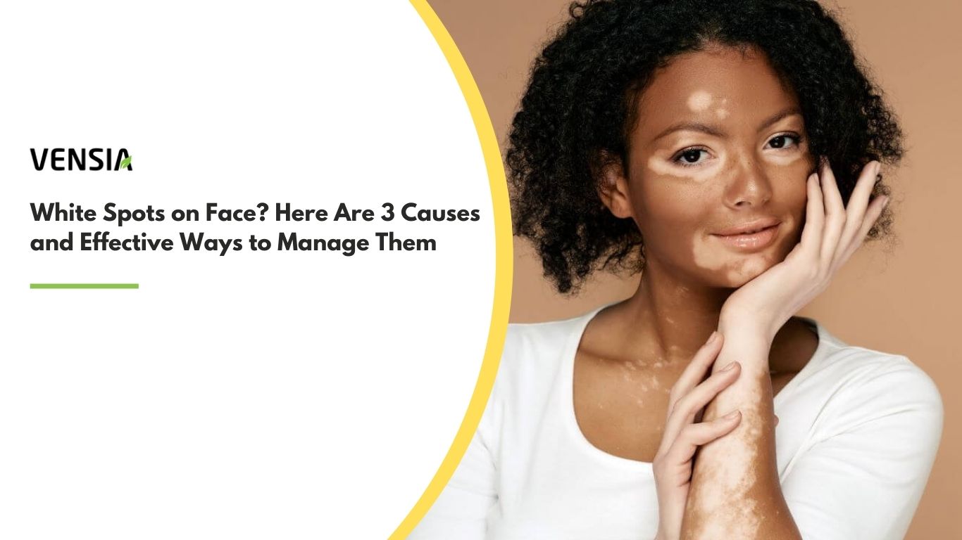 White Spots on Face? Here Are 3 Causes and Effective Ways to Manage Th
